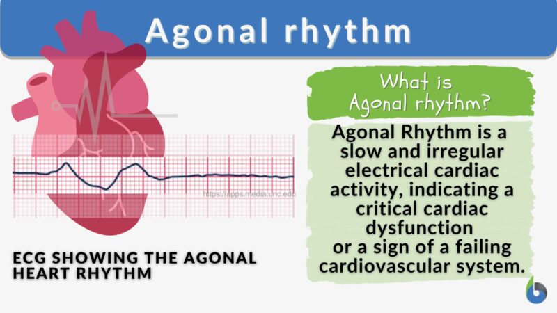 Agonal rhythm - Definition and Examples - Biology Online Dictionary
