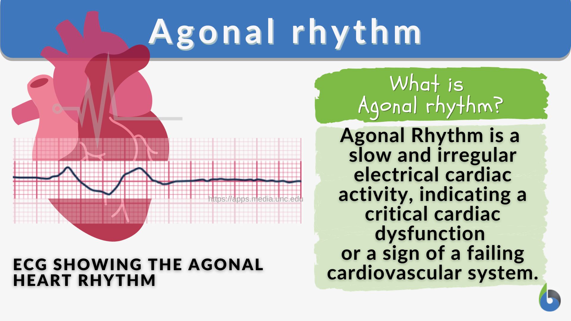 Agonal rhythm - Definition and Examples - Biology Online Dictionary