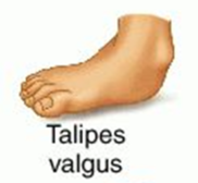Valgus - Definition and Examples - Biology Online Dictionary