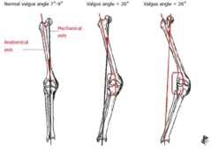 Valgus - Definition and Examples - Biology Online Dictionary