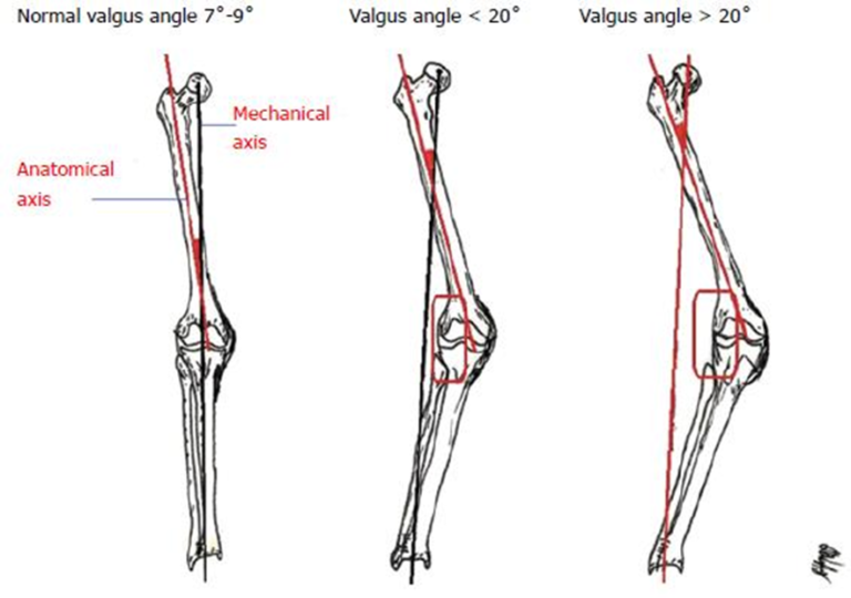 Valgus - Definition and Examples - Biology Online Dictionary