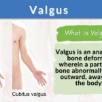 Cubitus Valgus And Cubitus Varus
