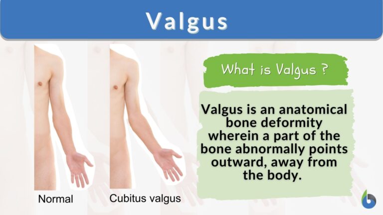 Valgus - Definition and Examples - Biology Online Dictionary