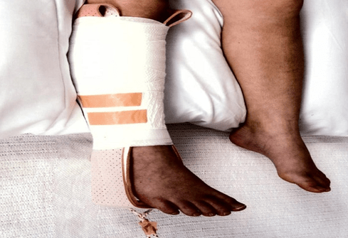 Buck's traction - Definition and Examples - Biology Online Dictionary