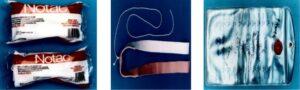 Buck's traction - Definition and Examples - Biology Online Dictionary
