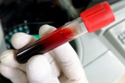 Hemolysis - Definition and Examples - Biology Online Dictionary